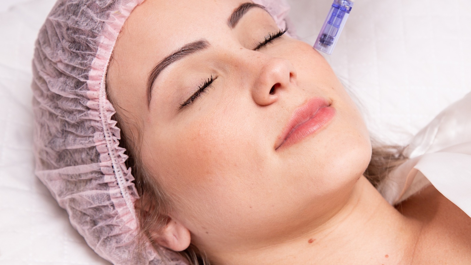 Microneedling Vs. Botox: Which Is The Right Treatment For You?