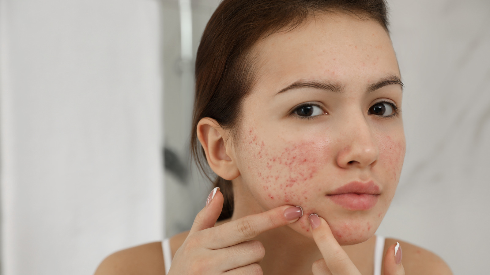 Minocycline Vs. Accutane: Which Acne Solution Boasts Better Results ...