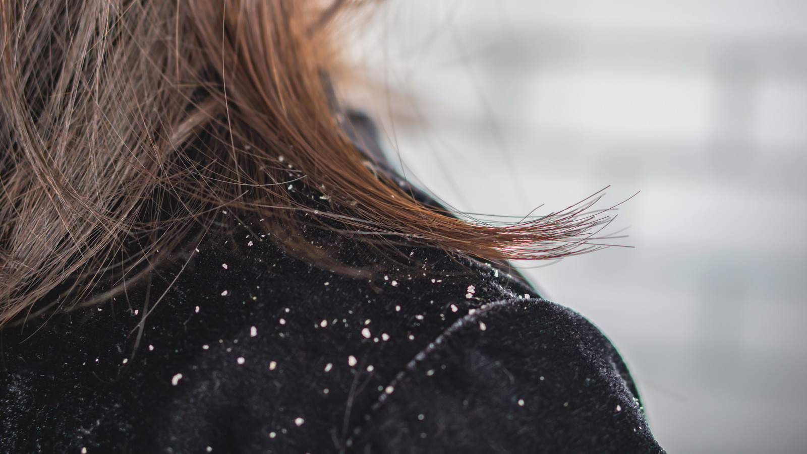 Summer Vs. Winter Dandruff: The Differences & How To Treat Both