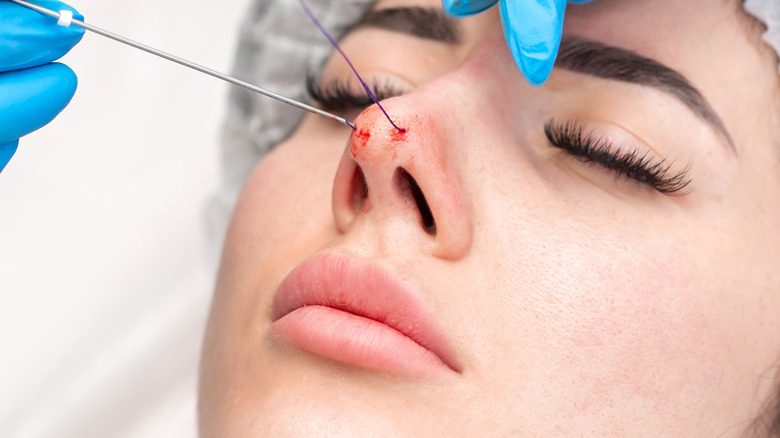 What You Need To Know Before Getting A Thread Lift What You Need To Know Before Getting A Thread Lift